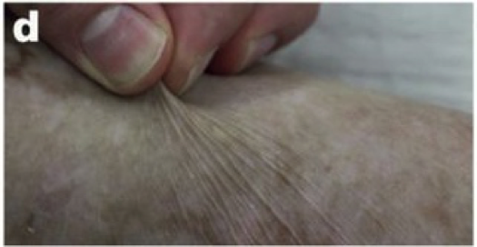 Dying boy’s ‘butterfly’ skin completely restored by gene therapy – I ...